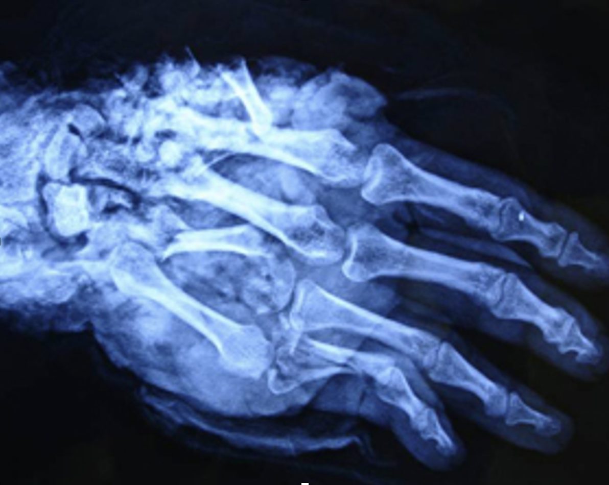 Parmak Kırıkları - Dr. Berkan Mersa